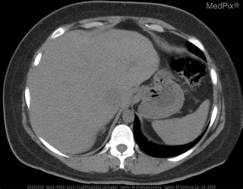 Focal Nodular Hyperplasia Liver