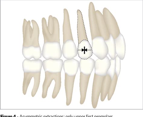 Figure 4 From Asymmetric Extractions In Orthodontics Semantic Scholar