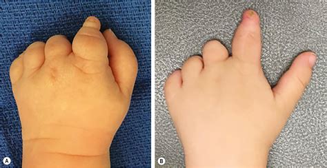 Congenital Hand Iii Malformations Abnormal Axis Differentiation