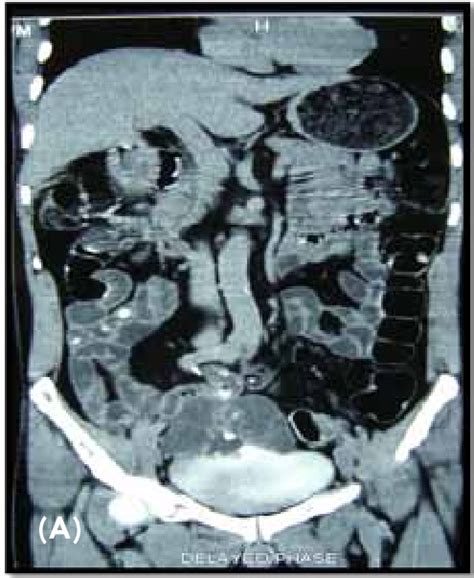 Ab Computer Tomography Revealed Lobulated Cystic Mass With Internal