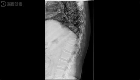 胸椎骨折手术治疗费用大概多少 医疗科普 百度健康