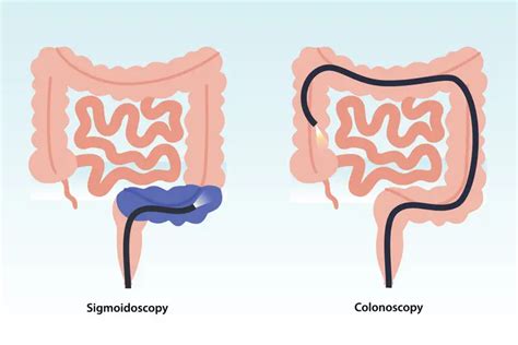 Colonoscopy Vs Sigmoidoscopy