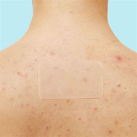 Miracle Patch Xl Spot Control Cover Body Acne Acne Spots Pimples