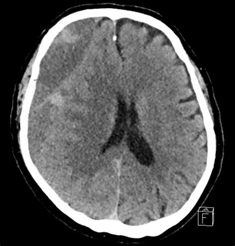 Non Contrast Ct Head Axial Image Showing Mixed Density Of Sdh Overlying