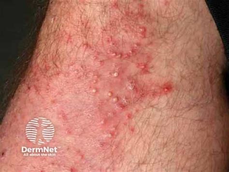 Folliculitis Image
