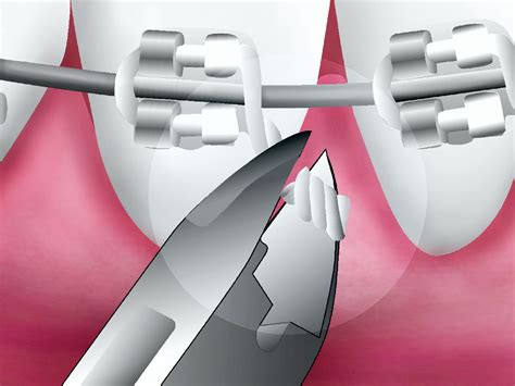 How To Fix A Broken Braces Wire 6 Steps With Pictures