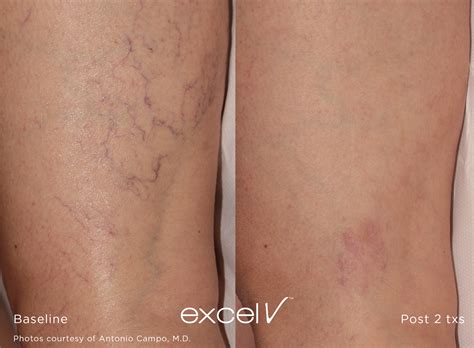 Spider Veins Specialist Cedar Park Tx Luxe Laser And Wellness Spa