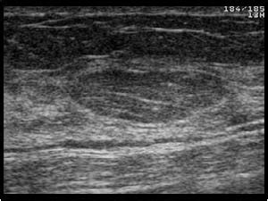 Breast And Axilla 51 Benign Lesions Case 517 Lipomas