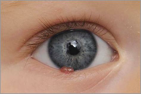 Lower Eyelid Lesion External Eye Disease Jama Ophthalmology Jama