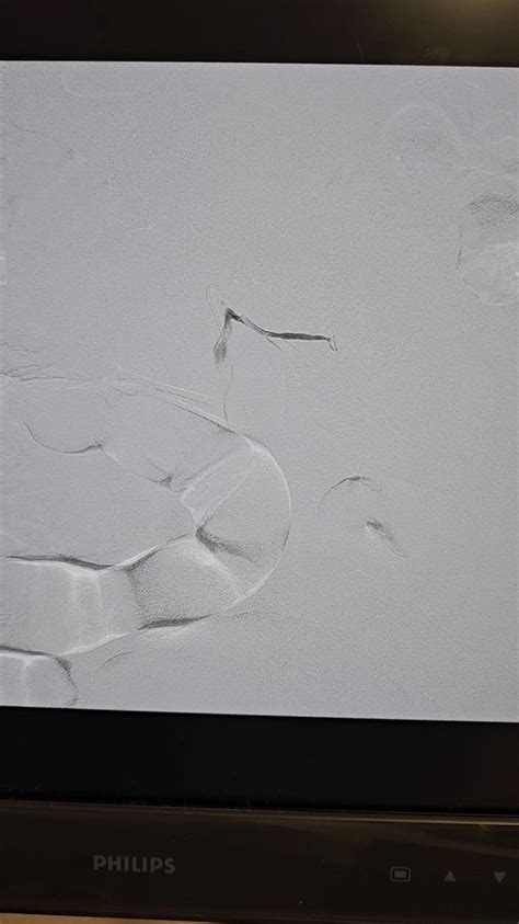 Renal Artery Embolization Rradiology