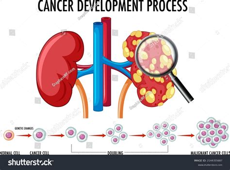 Diagram Showing Cancer Development Process Illustration Stock Vector