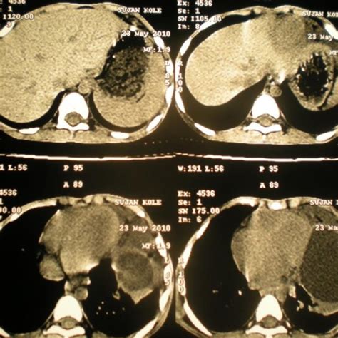 Cect Lung Showing Pulmonary Teratoma Download Scientific Diagram