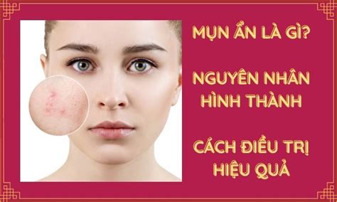 Mụn ẩn Là Gì Nguyên Nhân Và Cách điều Trị Hiệu Quả Seoul Center