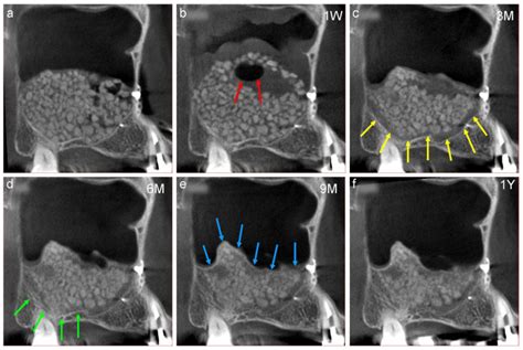A Comprehensive Clinical Review Of Maxillary Sinus Floor Elevation In
