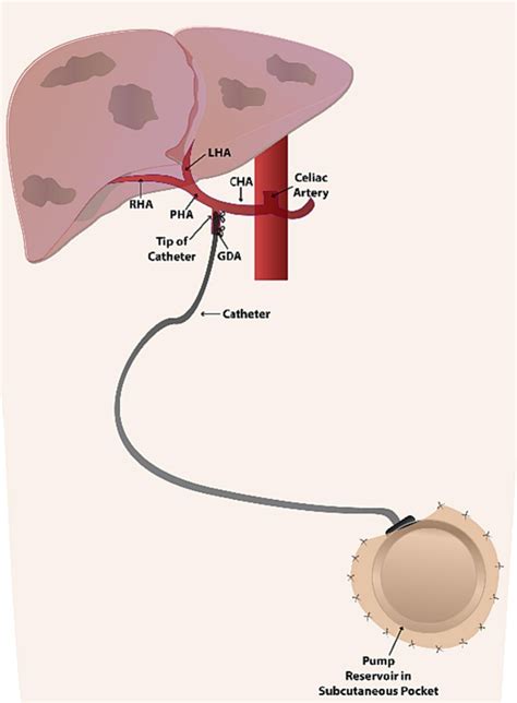 Imaging Of The Hepatic Arterial Infusion Pump Primer For Radiologists