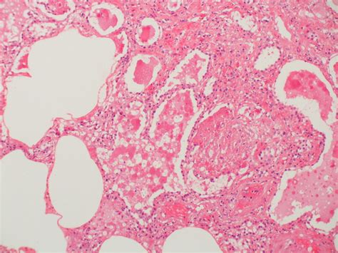 Flickriver Pulmonary Pathology Societys Photos Tagged With Histoplasmosis