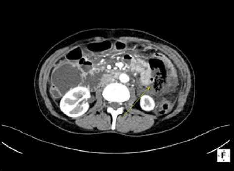 Ct Scan Of The Abdomen Revealed Abdominal Fluid Collection With Air