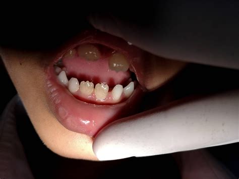 Understanding Mamelons In Teeth Causes Concerns And Cosmetic Treatments
