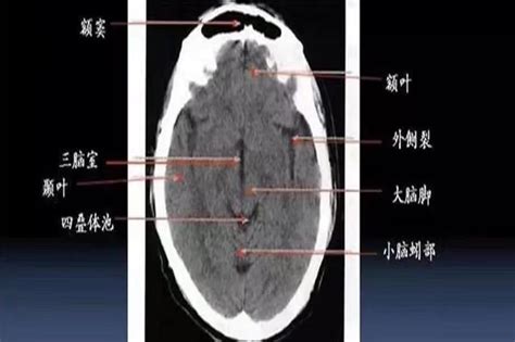 头颅ct断层解剖图
