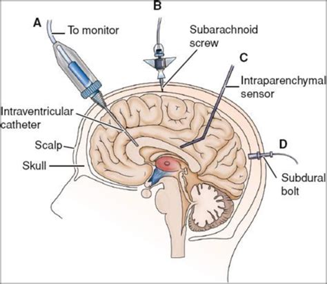 Intracranial Pressure Flashcards Quizlet