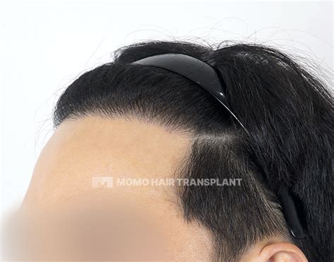 모발이식 집중진료 모모성형외과