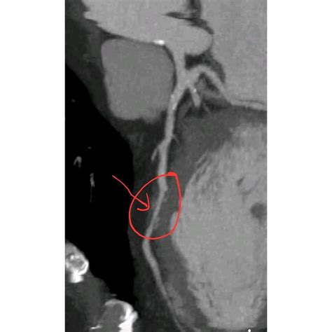 Ebrahim A Dorgham Ead On Linkedin Mid Lad Myocardial Bridge Mohamed