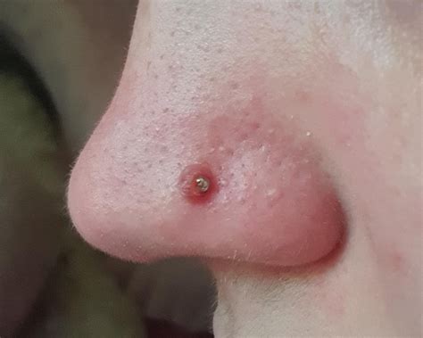 Irritation Bump On Nostril Piercing Rpiercing
