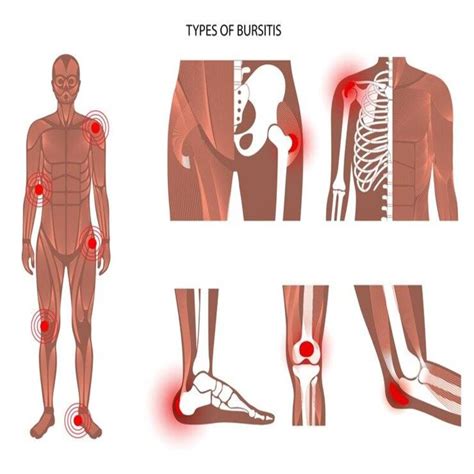 Bursitis Symptoms Causes And Diagnosis
