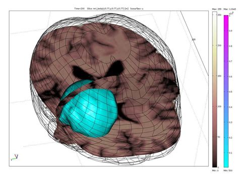 Tumor Iso Concentration Surface At A Given Time Embedded In The