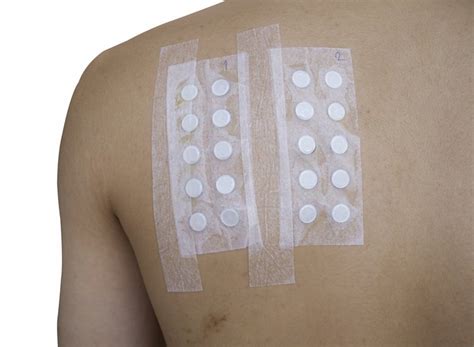 Allergy Patch Testing — Shades Dermatology Graceville Brisbane