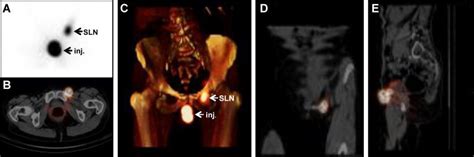 Sentinel Lymph Node Biopsy In Vulvar Cancer Using Combined Radioactive