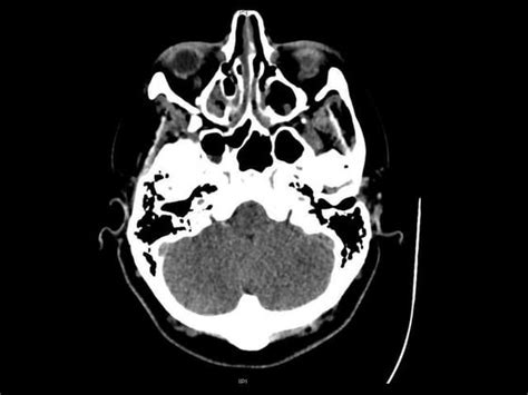 Hypoxic Ischemic Encephalopathy Lecture On Hie Ppt Pregnancy