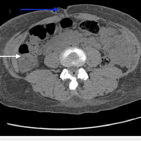 Ct Scan Of The Abdomen And Pelvis Without Contrast White Arrow Stool