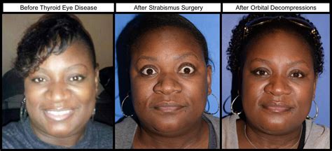 Thank You To The Thyroid Eye Clinic For Straightening My Eyes And