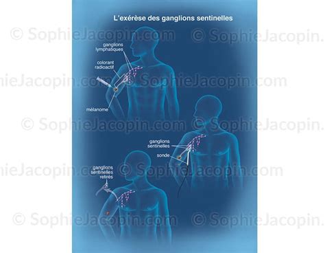 EXÉRÈSE GANGLIONS SENTINELLES illustration medicale Sophie Jacopin
