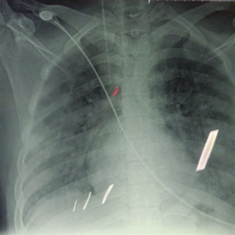 Image Showing Petechiae Rashes On The Right Shoulder Download