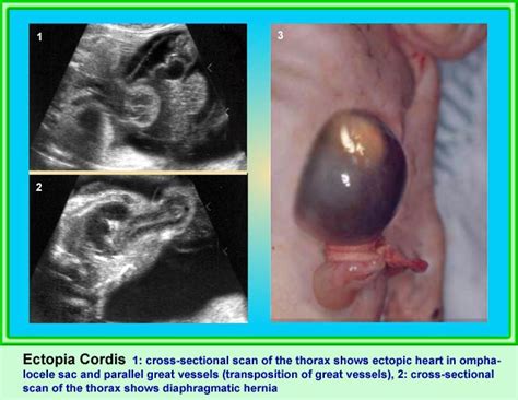 Ectopia Cordis Department Of Obstetrics And Gynecology Faculty Of