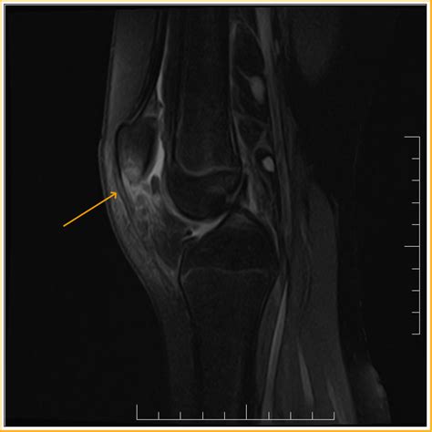 Lateral Patellar Dislocation Sumer S Radiology Blog