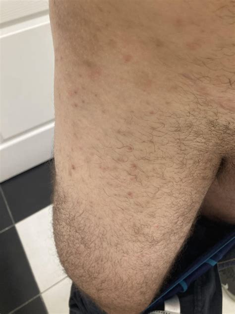 Post Scabies Or Folliculitis R Folliculitis