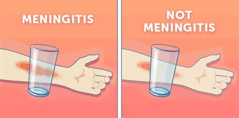 Meningitis Glass Test