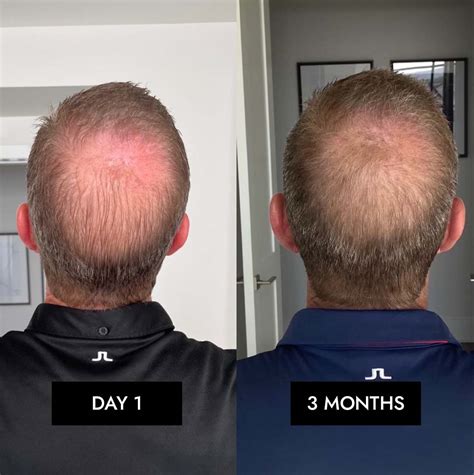 Hair Loss Treatment For Men Genetic Testing Telehealth Visits