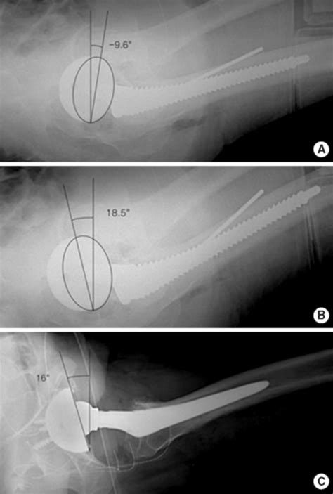 A The Acetabular Cup Was 9° Retroverted In The Initial Portable Download Scientific Diagram