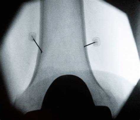The Benefits Of Using Fluoroscopy In Genicular Nerve