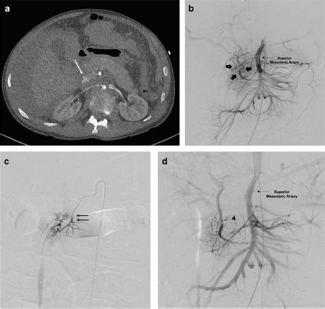 Lymphatic Plastic Bronchitis Secondary To Thoracic Duct Stenosis Mayo My Xxx Hot Girl