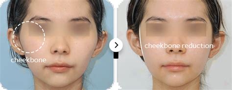 Cheekbone Reduction Surgery Before And After