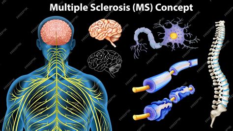 Diagram Showing Multiple Sclerosis Concept Premium Vector
