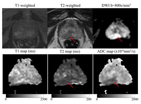 Figure A Year Old Patient With Prostate Imaging Reporting And