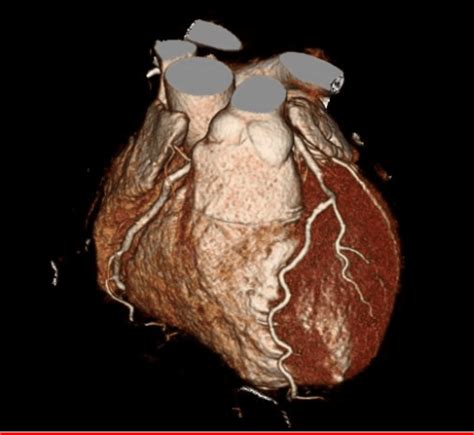 3d Cardiac Caseys Blog