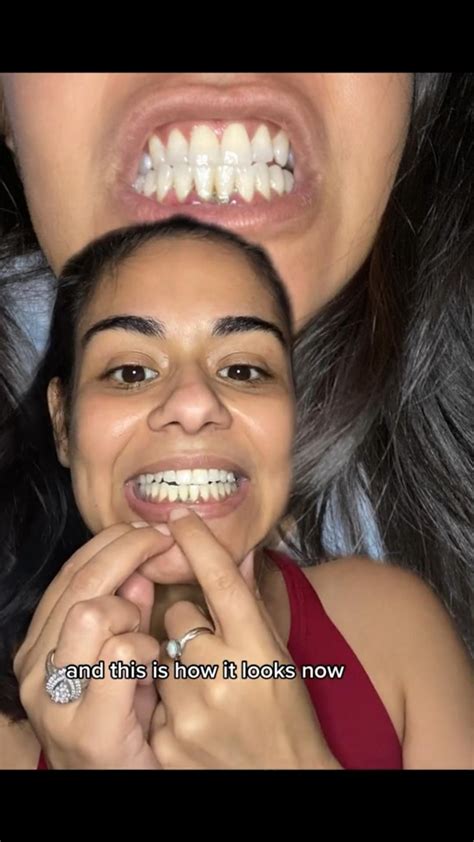 Coconut Oil Pulling Artofit