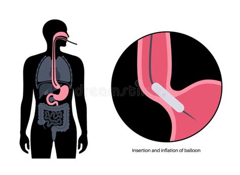 Pneumatic Dilation Stock Illustrations 18 Pneumatic Dilation Stock